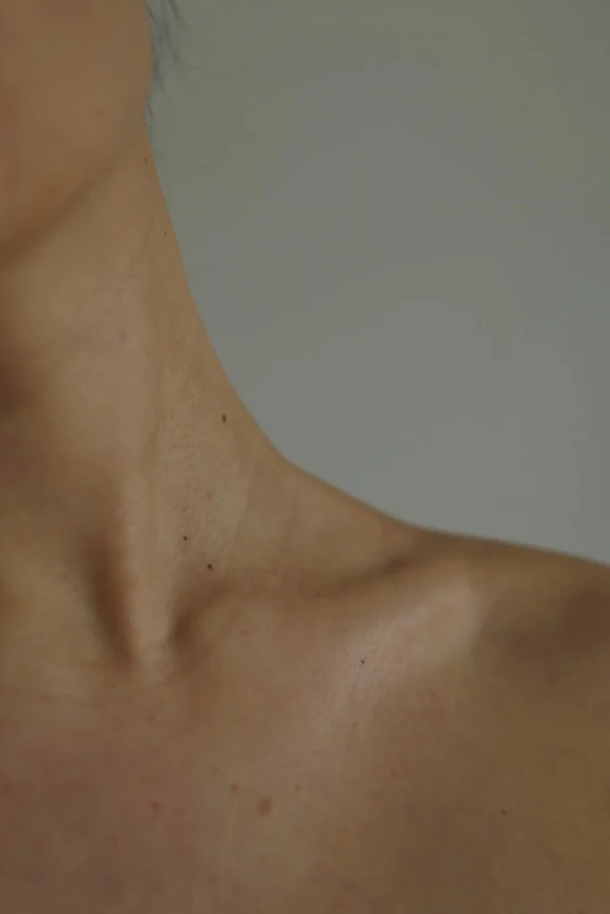 Liposuctie hals met Tumescent Techniek | Lipology Clinic